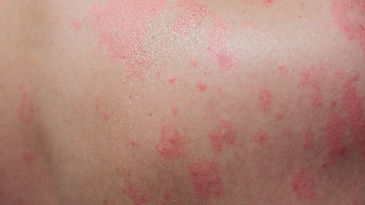 【知恵袋】ぺニスに赤い発疹ができた時の原因と考えられる病気 知恵袋note